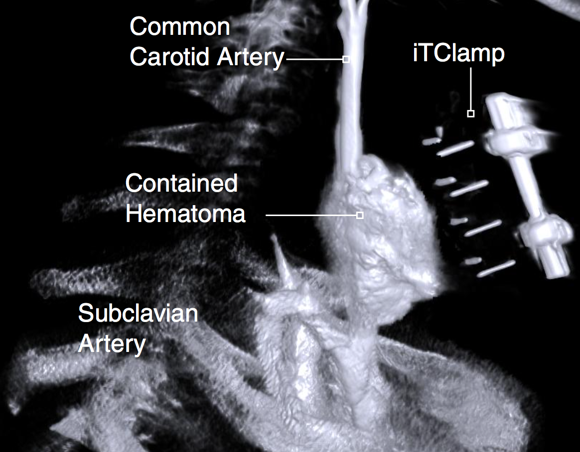 iTClamp - система экстренного гемостаза - WETLAB