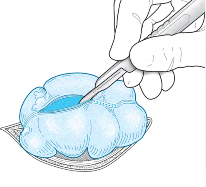 The formation of the intestinal stoma and the principles of caring for ...