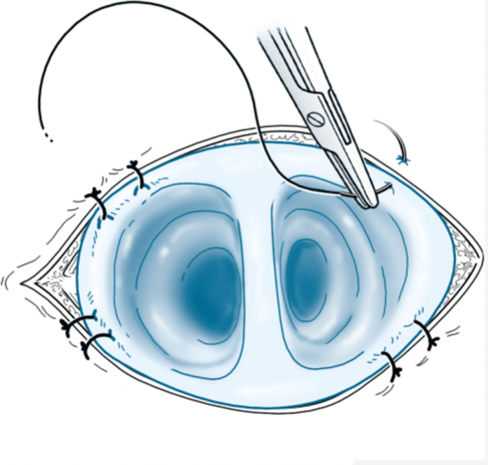 The formation of the intestinal stoma and the principles of caring for ...